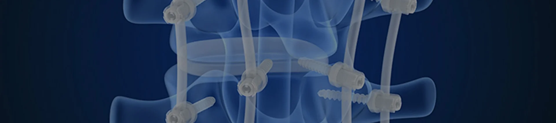 Posterior Lumbar Interbody Fusion (PLIF) in Delhi