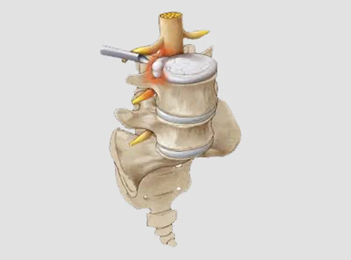 Get Best Outcomes from Endoscopic Spine Surgeries| IBS Hospital