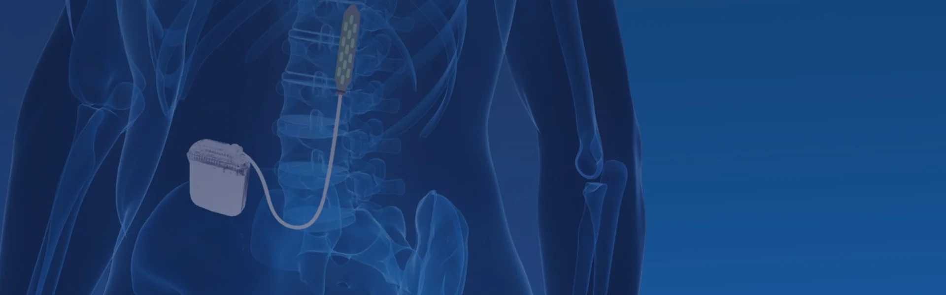 Best Epidural Stimulation | Advanced Treatment Solutions | IBS Hospital