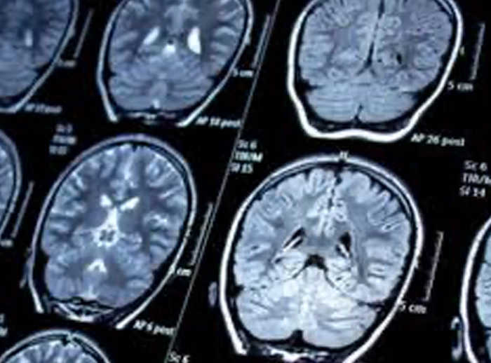 Personalized Brain Mapping | Advanced Treatments | IBS Hospital