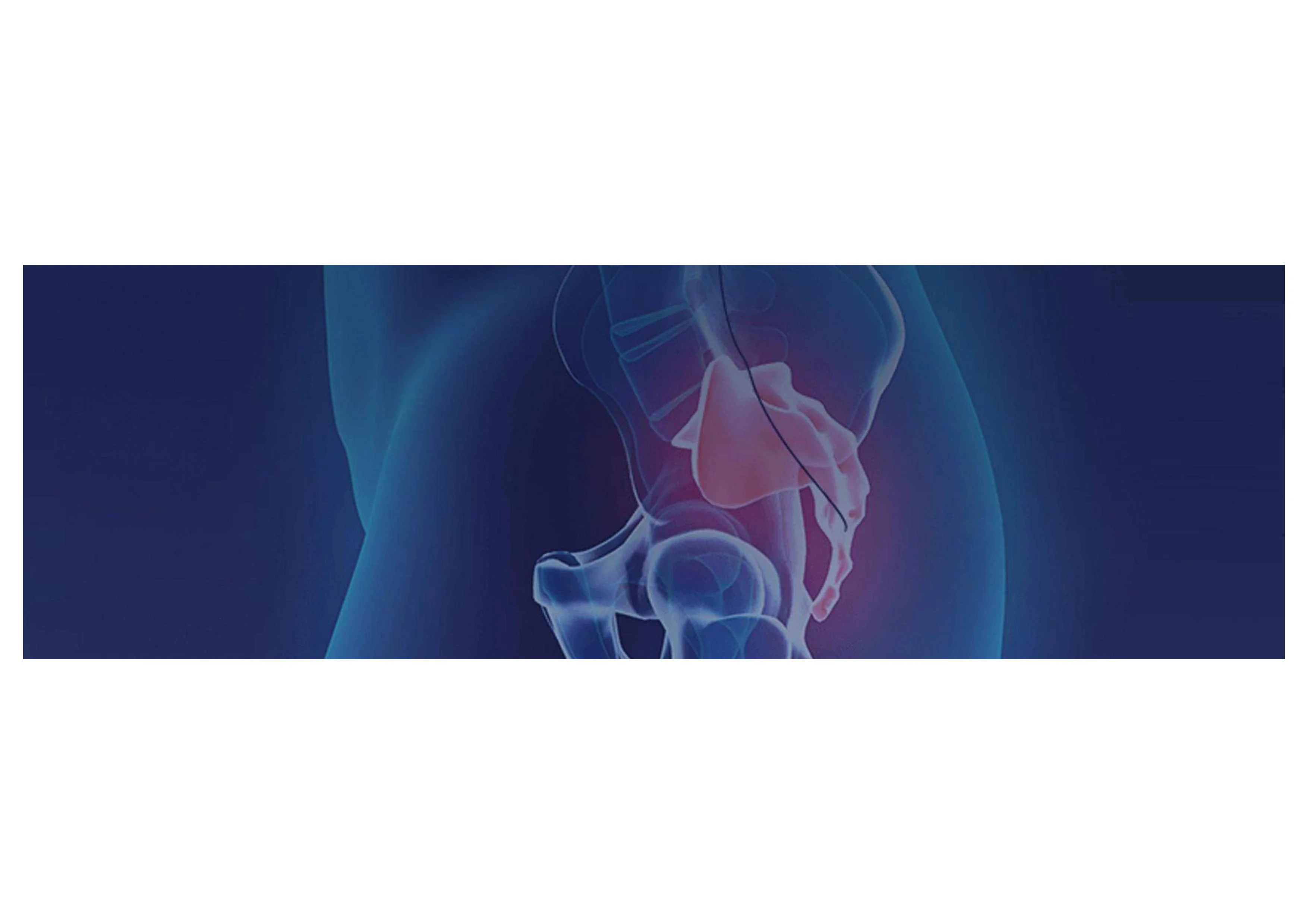 Improved Quality of Life with Sacral Nerve Stimulation | IBS Hospital