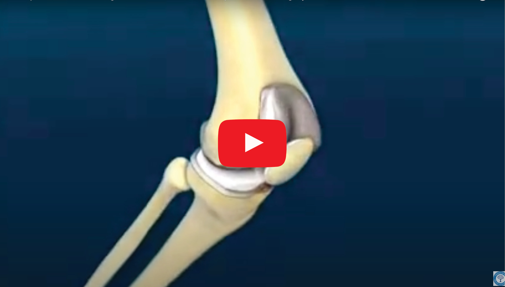 Knee Replacement Surgery in Delhi - IBS Hospital