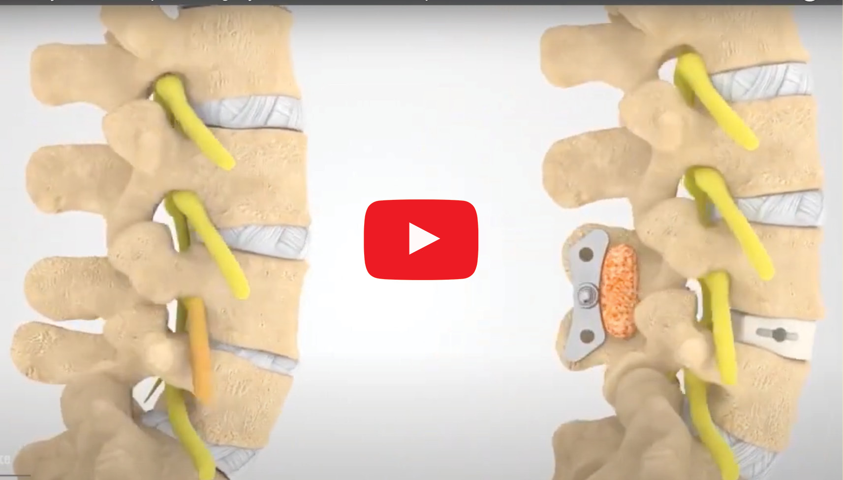 Minimal Invasive Spine Surgeries in Delhi - IBS Hospital