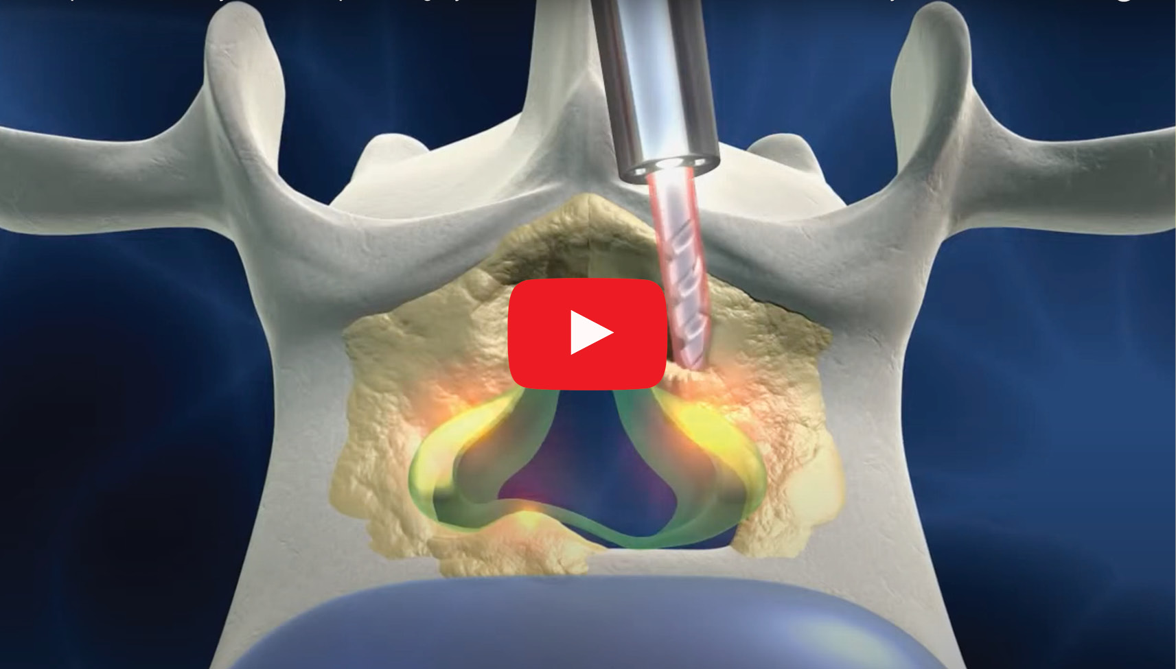 Minimal Invasive Spine Surgeries in Delhi - IBS Hospital