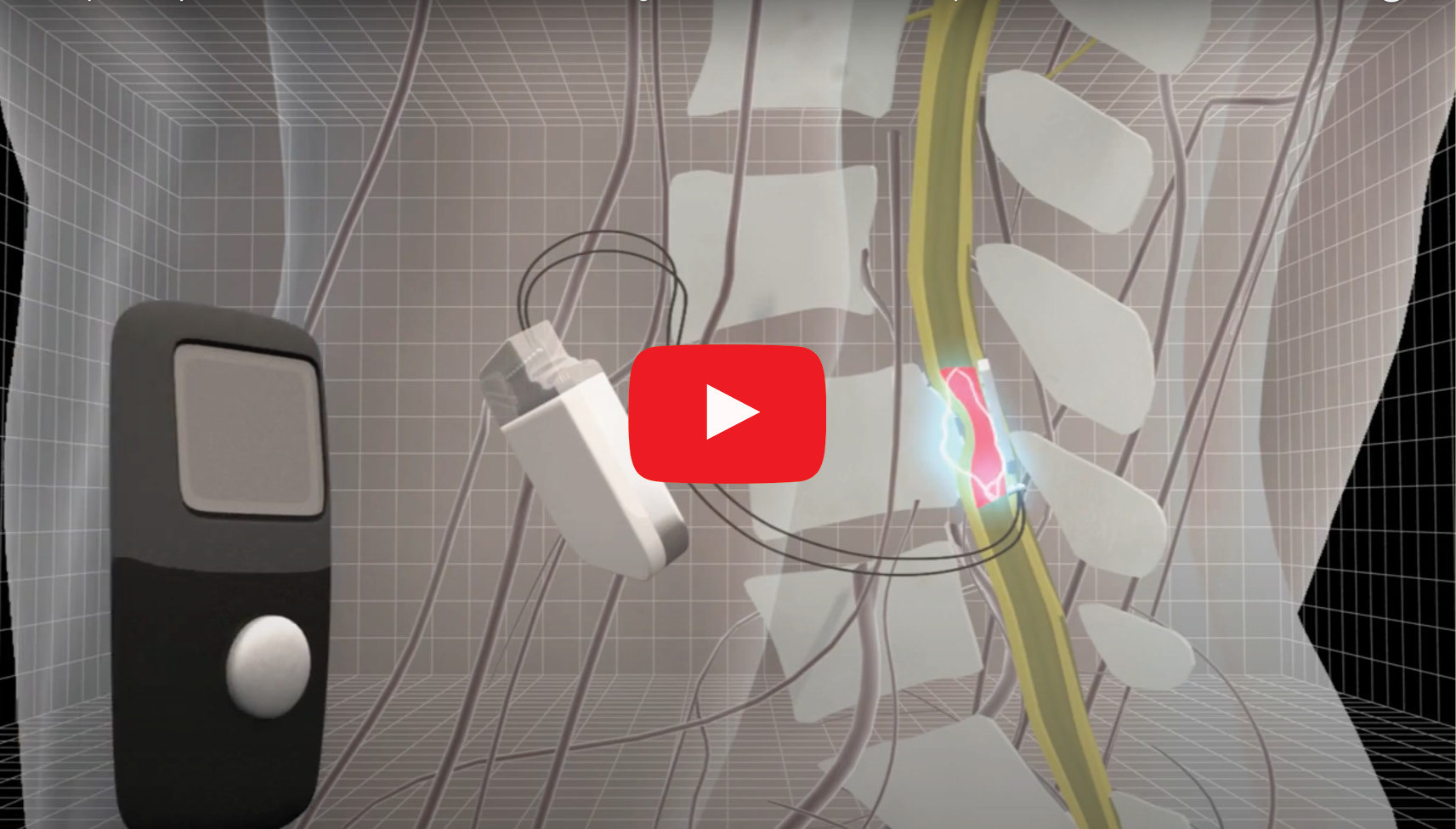Neuromodulation Treatment: Types, Surgeries and Doctors