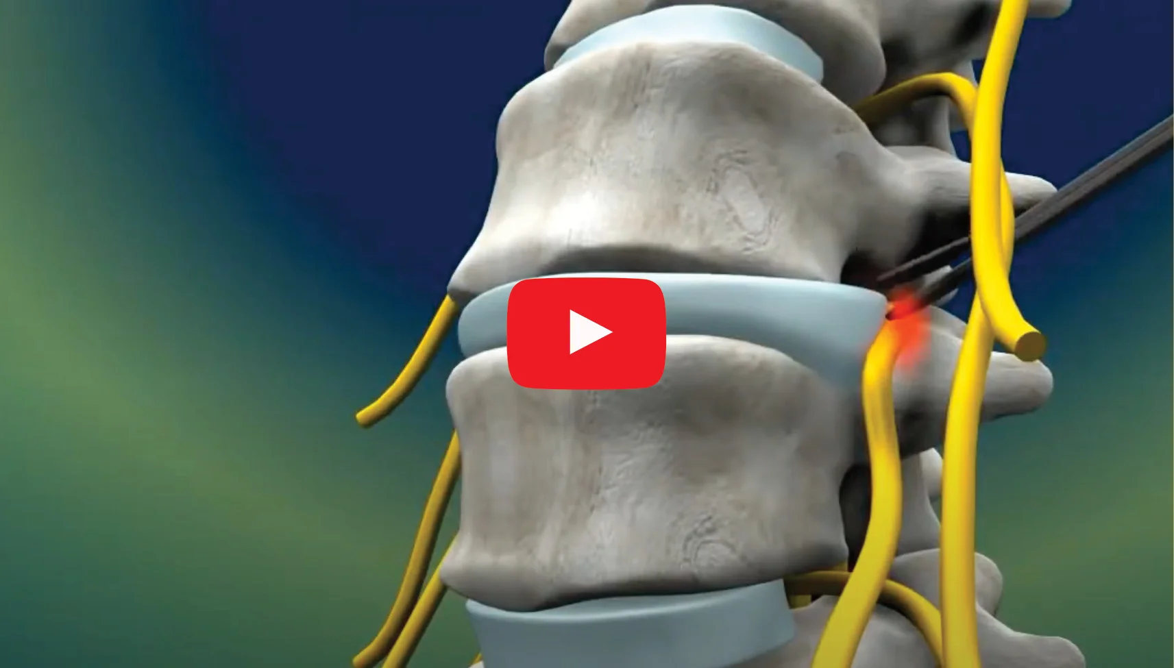 Microscopic Discectomy Recovery and Treatment in Delhi